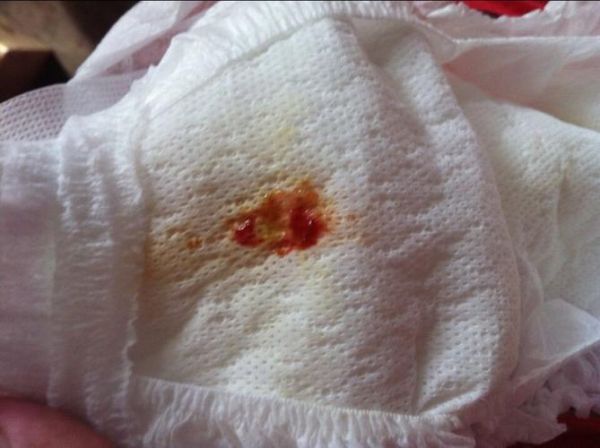 果酱样便是什么病_果酱样便怎么办-第2张图片-山城妙识 果酱样便是什么病_果酱样便怎么办-第2张图片-山城妙识