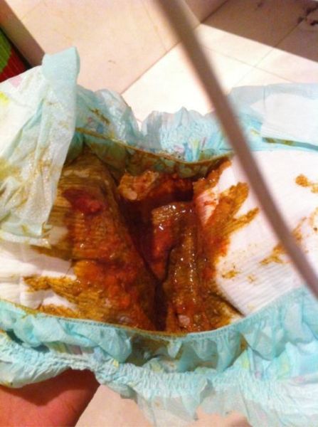 果酱样便是什么病_果酱样便怎么办-第3张图片-山城妙识 果酱样便是什么病_果酱样便怎么办-第3张图片-山城妙识