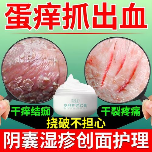 蛋皮痒用什么药膏最好_蛋皮痒怎么快速止痒-第3张图片-山城妙识