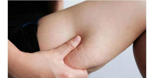 橘皮组织怎么消除_橘皮组织是怎么形成的-第1张图片-山城妙识 橘皮组织怎么消除_橘皮组织是怎么形成的-第1张图片-山城妙识