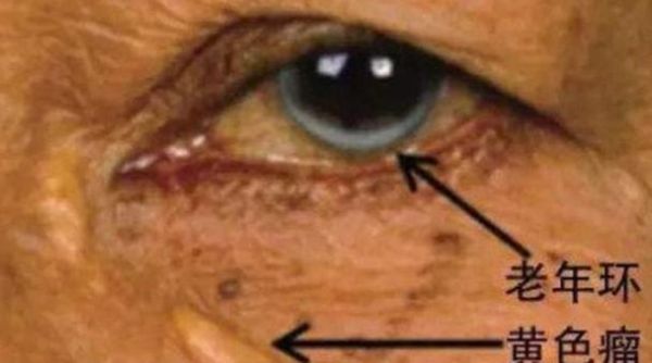 血脂高眼睛有哪些症状_高血脂眼部信号-第3张图片-山城妙识