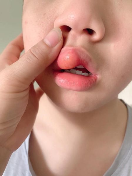 嘴唇起泡是什么原因_睡一觉醒来上唇肿了怎么办-第3张图片-山城妙识
