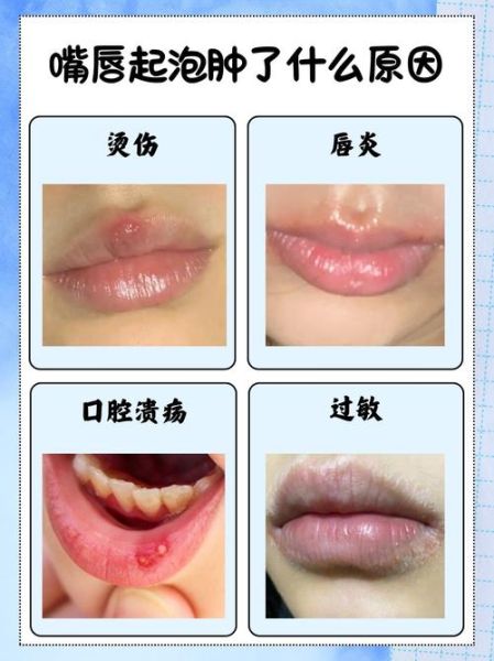 嘴唇起泡是什么原因_睡一觉醒来上唇肿了怎么办-第1张图片-山城妙识