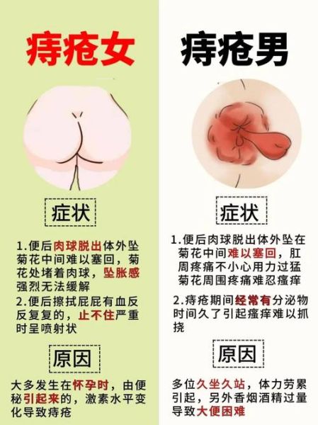 痔疮一期二期三期图片_如何区分严重程度-第2张图片-山城妙识 痔疮一期二期三期图片_如何区分严重程度-第2张图片-山城妙识