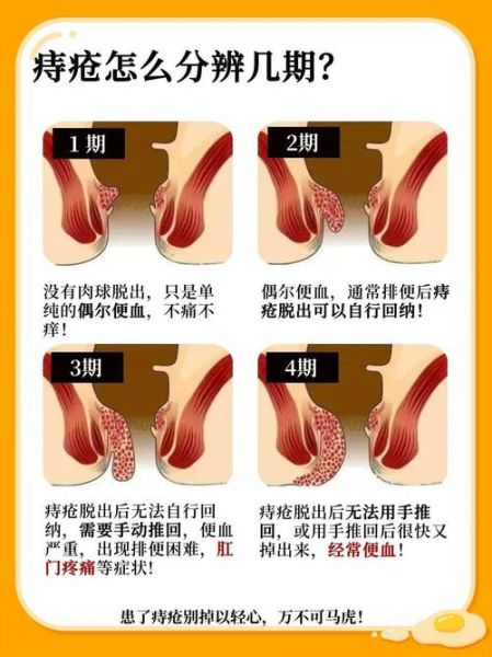 痔疮一期二期三期图片_如何区分严重程度-第1张图片-山城妙识 痔疮一期二期三期图片_如何区分严重程度-第1张图片-山城妙识