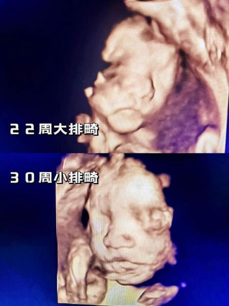 大排畸和小排畸检查区别_什么时候做最合适-第2张图片-山城妙识 大排畸和小排畸检查区别_什么时候做最合适-第2张图片-山城妙识