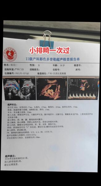 大排畸和小排畸检查区别_什么时候做最合适-第3张图片-山城妙识 大排畸和小排畸检查区别_什么时候做最合适-第3张图片-山城妙识