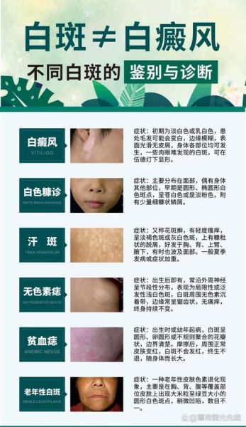 色素减退白斑是怎么造成的_白斑初期症状有哪些-第2张图片-山城妙识 色素减退白斑是怎么造成的_白斑初期症状有哪些-第2张图片-山城妙识