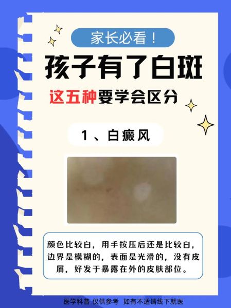 色素减退白斑是怎么造成的_白斑初期症状有哪些-第1张图片-山城妙识 色素减退白斑是怎么造成的_白斑初期症状有哪些-第1张图片-山城妙识