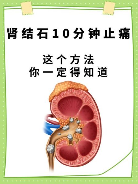 肾结石最快的止痛方法_如何缓解肾结石疼痛-第3张图片-山城妙识 肾结石最快的止痛方法_如何缓解肾结石疼痛-第3张图片-山城妙识