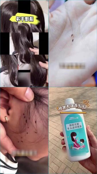 虱子卵怎么彻底去除_虱子卵用什么药最有效-第3张图片-山城妙识