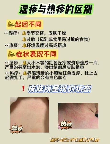 怎么判断是不是湿疹_湿疹初期症状有哪些-第1张图片-山城妙识