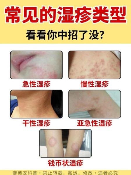 怎么判断是不是湿疹_湿疹初期症状有哪些-第3张图片-山城妙识