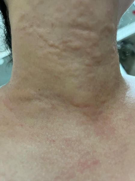 蝉蛹过敏怎么办_蝉蛹过敏症状有哪些-第3张图片-山城妙识 蝉蛹过敏怎么办_蝉蛹过敏症状有哪些-第3张图片-山城妙识