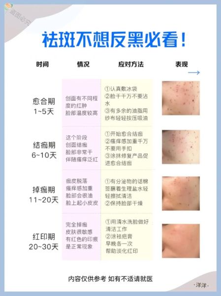 祛斑效果最好的方法_如何快速祛斑不反弹-第1张图片-山城妙识 祛斑效果最好的方法_如何快速祛斑不反弹-第1张图片-山城妙识