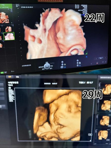 大排畸和四维都要做吗_四维和大排畸区别-第3张图片-山城妙识 大排畸和四维都要做吗_四维和大排畸区别-第3张图片-山城妙识