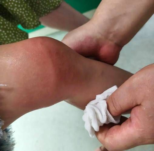 被海蜇咬了什么症状_被海蜇咬了怎么办-第3张图片-山城妙识