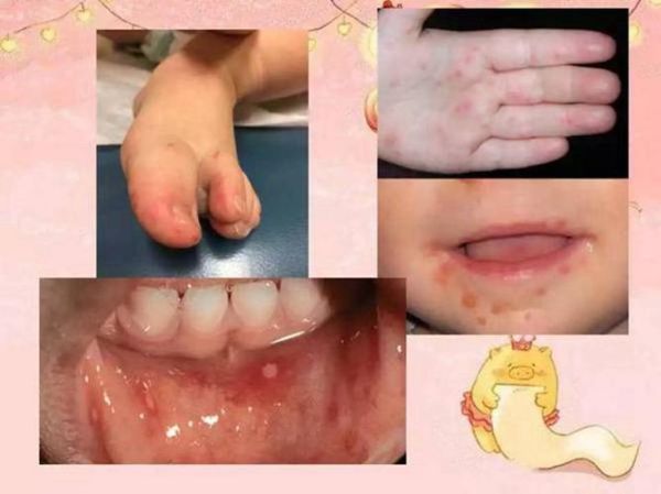 手足口病初期症状图片_如何辨别-第2张图片-山城妙识 手足口病初期症状图片_如何辨别-第2张图片-山城妙识