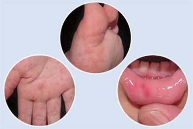 手足口病初期症状图片_如何辨别-第3张图片-山城妙识 手足口病初期症状图片_如何辨别-第3张图片-山城妙识