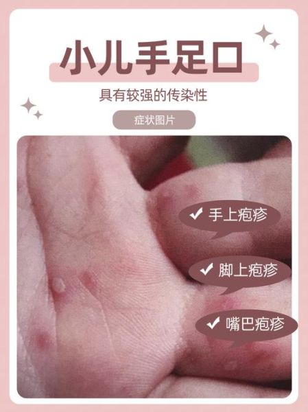手足口病初期症状图片_如何辨别-第1张图片-山城妙识 手足口病初期症状图片_如何辨别-第1张图片-山城妙识