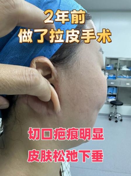 小拉皮手术害了我_小拉皮手术失败怎么办-第1张图片-山城妙识