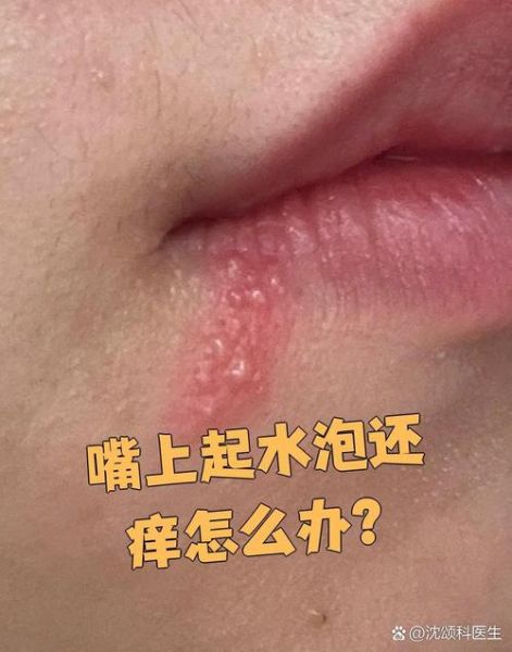 嘴唇上长水泡可以涂红霉素软膏吗_多久能好-第2张图片-山城妙识
