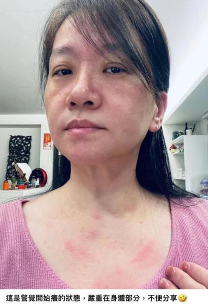 海鲜过敏是什么原因_海鲜过敏症状有哪些-第1张图片-山城妙识