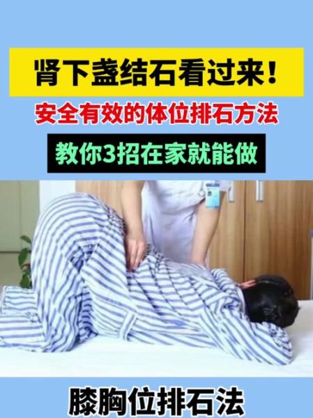 肾结石怎么快速排出_三个动作真的有用吗-第1张图片-山城妙识 肾结石怎么快速排出_三个动作真的有用吗-第1张图片-山城妙识