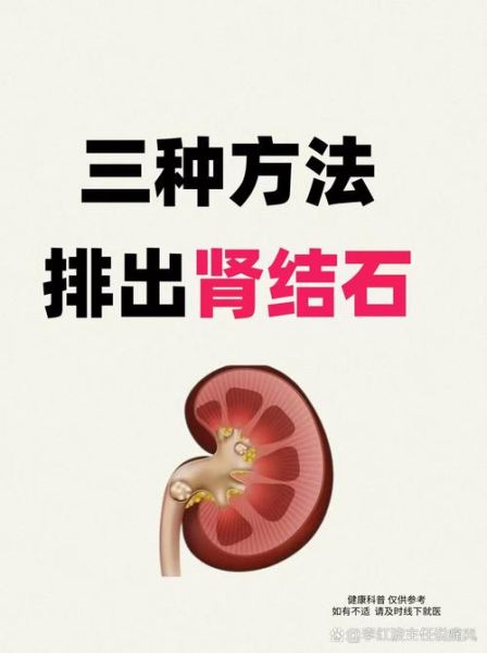 肾结石怎么快速排出_三个动作真的有用吗-第2张图片-山城妙识 肾结石怎么快速排出_三个动作真的有用吗-第2张图片-山城妙识