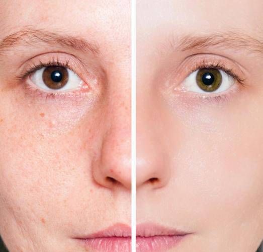 果酸祛痘效果怎么样_果酸换肤去痘印多久见效-第1张图片-山城妙识 果酸祛痘效果怎么样_果酸换肤去痘印多久见效-第1张图片-山城妙识