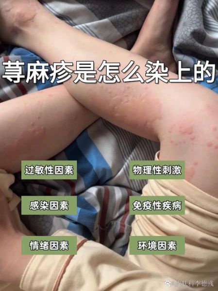 过敏性荨麻疹的症状有哪些_过敏性荨麻疹怎么治疗-第1张图片-山城妙识 过敏性荨麻疹的症状有哪些_过敏性荨麻疹怎么治疗-第1张图片-山城妙识