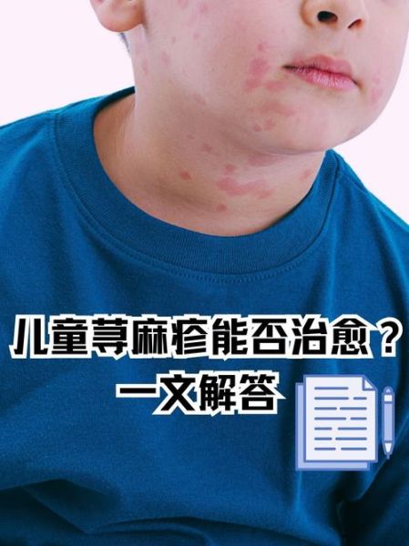 过敏性荨麻疹的症状有哪些_过敏性荨麻疹怎么治疗-第3张图片-山城妙识 过敏性荨麻疹的症状有哪些_过敏性荨麻疹怎么治疗-第3张图片-山城妙识