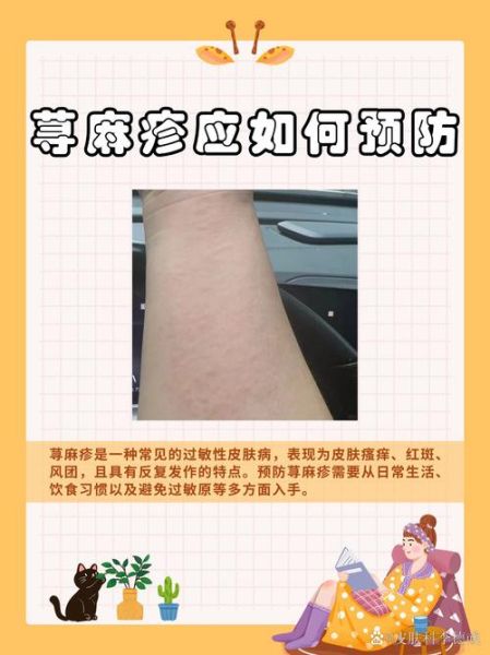 过敏性荨麻疹的症状有哪些_过敏性荨麻疹怎么治疗-第2张图片-山城妙识 过敏性荨麻疹的症状有哪些_过敏性荨麻疹怎么治疗-第2张图片-山城妙识