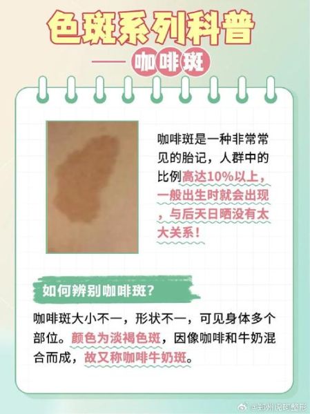 牛奶咖啡斑与胎记区别_如何分辨-第1张图片-山城妙识