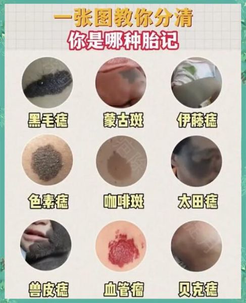 牛奶咖啡斑与胎记区别_如何分辨-第3张图片-山城妙识