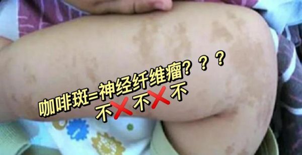 牛奶咖啡斑与胎记区别_如何分辨-第2张图片-山城妙识