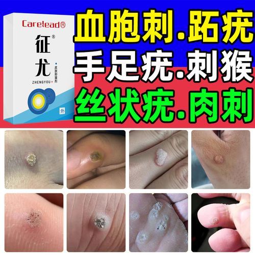 醋精加白面去疣的正确方法_多久能见效-第3张图片-山城妙识