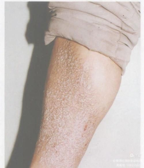 淀粉样变皮肤病图片_早期症状识别-第1张图片-山城妙识