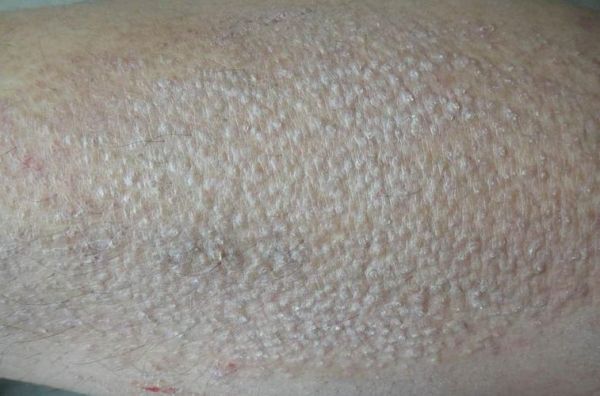 淀粉样变皮肤病图片_早期症状识别-第2张图片-山城妙识