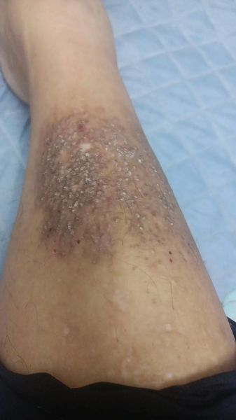 淀粉样变皮肤病图片_早期症状识别-第3张图片-山城妙识