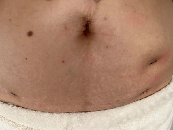 巧克力囊肿如何根治_巧克力囊肿手术后会复发吗-第2张图片-山城妙识