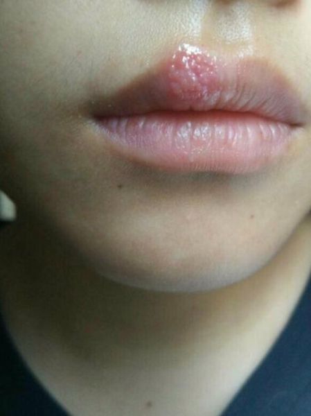 嘴唇上起一串透明小水泡_怎么回事-第2张图片-山城妙识
