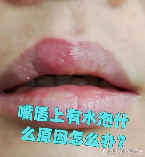 嘴唇上起一串透明小水泡_怎么回事-第3张图片-山城妙识