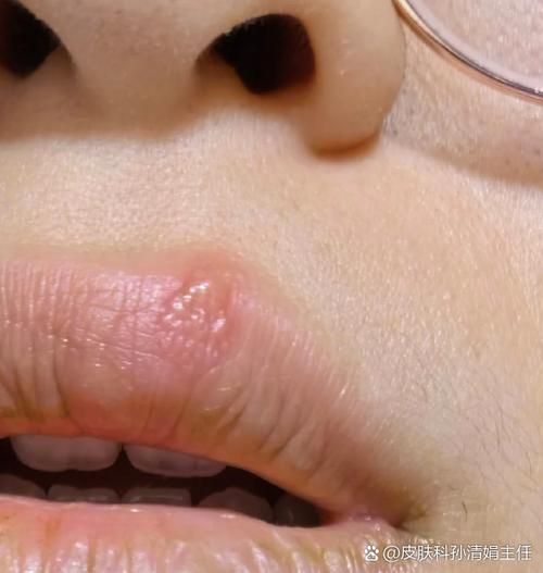 嘴唇上起一串透明小水泡_怎么回事-第1张图片-山城妙识