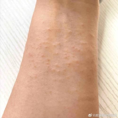 当归苦参丸治疗湿疹有效吗_湿疹反复发作怎么办-第3张图片-山城妙识