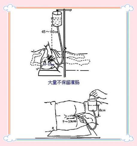 灌肠怎么灌_灌肠的正确方法-第2张图片-山城妙识 灌肠怎么灌_灌肠的正确方法-第2张图片-山城妙识