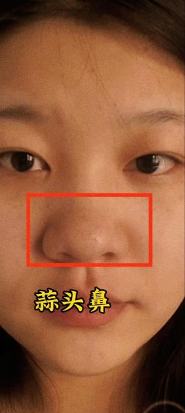 大蒜鼻整容效果图_真实案例-第1张图片-山城妙识 大蒜鼻整容效果图_真实案例-第1张图片-山城妙识