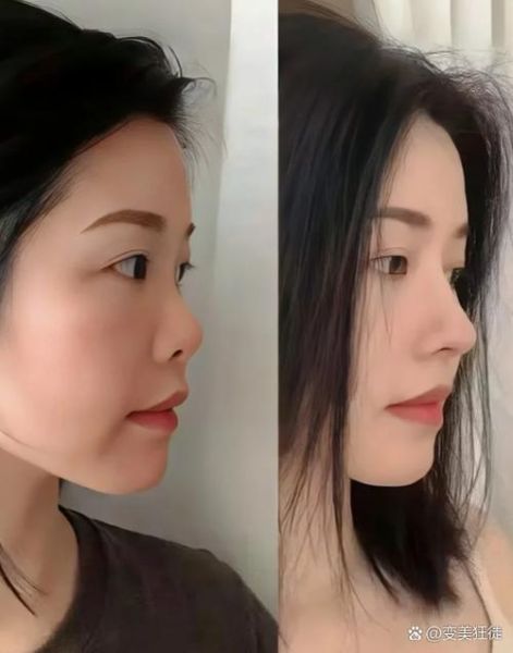 大蒜鼻整容效果图_真实案例-第2张图片-山城妙识 大蒜鼻整容效果图_真实案例-第2张图片-山城妙识