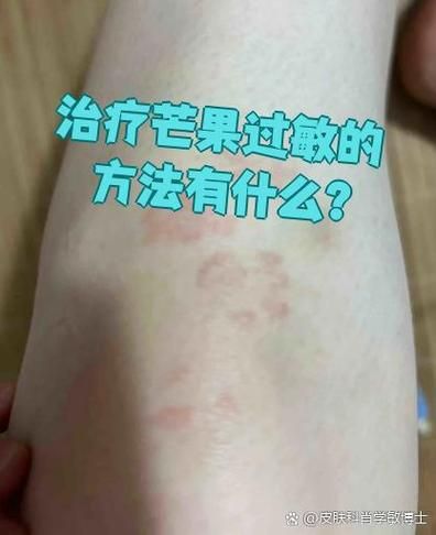小孩吃芒果过敏怎么办_芒果过敏急救步骤-第3张图片-山城妙识