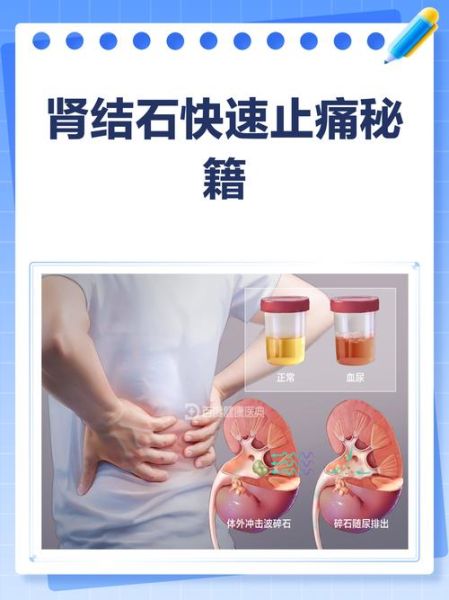 肾结石怎么办_肾结石怎么快速止痛-第1张图片-山城妙识